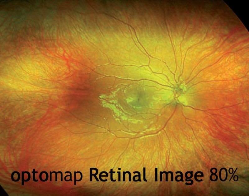 optomap | H&H Eyecare